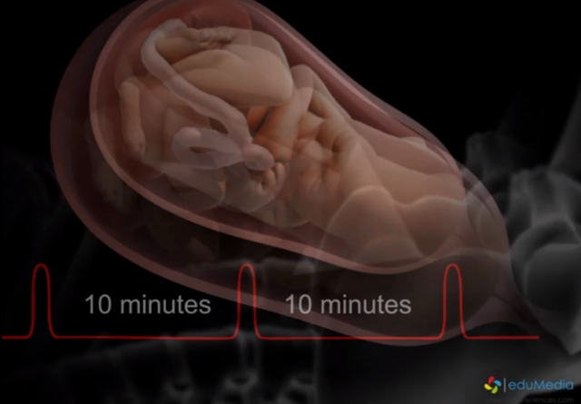 Pod - Accouchement 3d